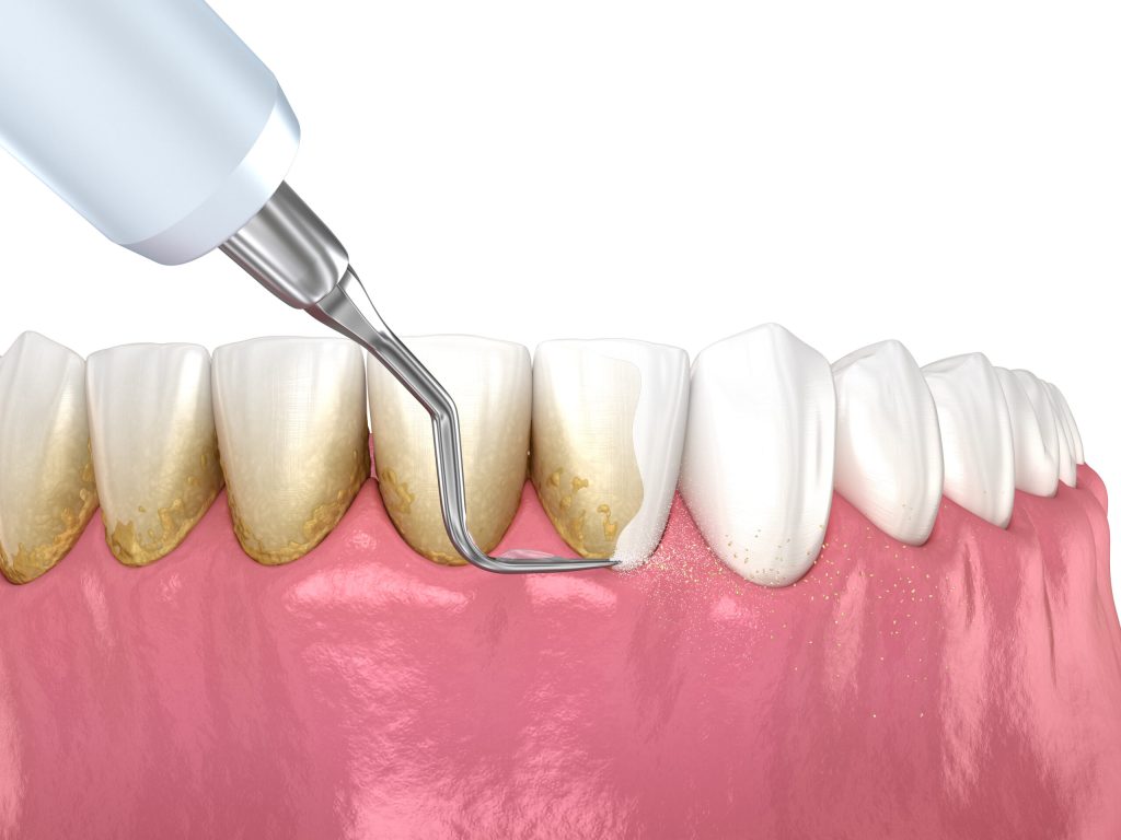Dental Cleaning in Hartford CT, Dental Scaling, Deep Teeth Cleaning ...